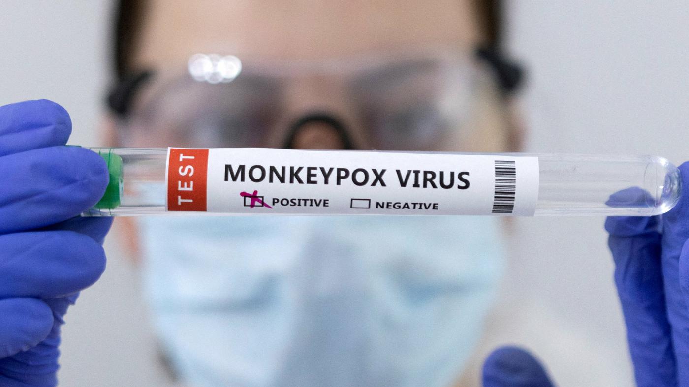 6600 bestätigte Fälle: USA verhängen nationalen Notstand wegen Affenpocken