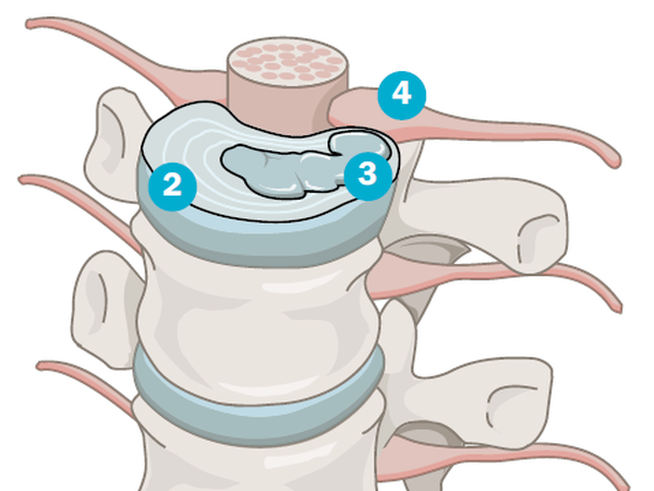 Arztbrief: Bandscheibe