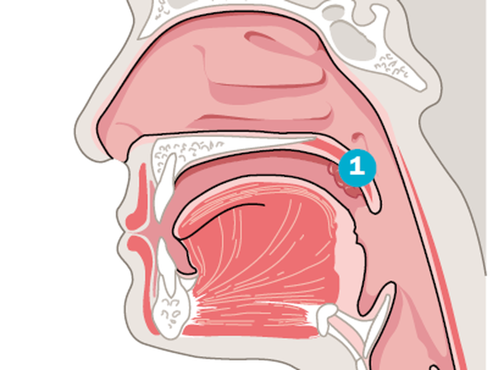 Mandeln entfernen: Von der Mandelentzündung bis zur Operation