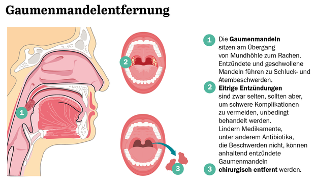 Entzündete Gaumenmandeln: Wann die Entfernung nötig ist – und wann sie ...
