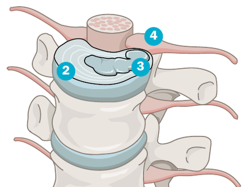 Arztbrief: Bandscheibe