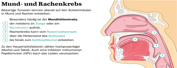 Krebs im Mund, Rachen oder Kehlkopf: Wie er entsteht und warum auch ...