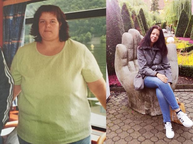 Magenverkleinerung bei Adipositas: „Vor dem Spiegel dachte ich, wer ist ...