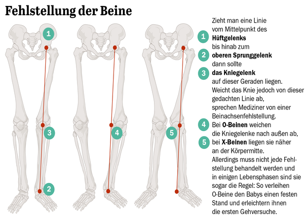 Sind X- und O-Beine bei Kindern normal?: Wann eine Fehlstellung ...