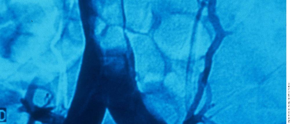 Blutgerinnsel: Gefährlicher Pfropf