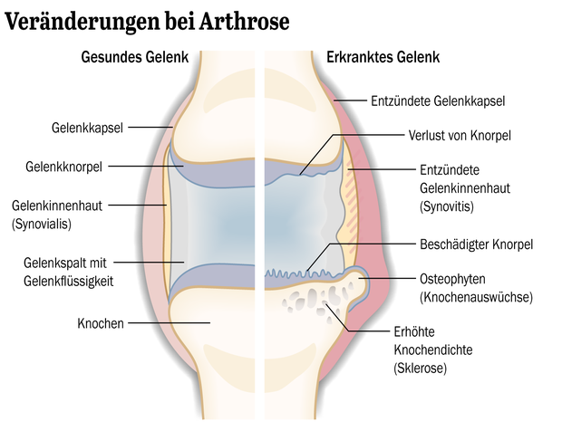 Radiosynoviorthese: Wie Strahlentherapie bei Arthrose helfen kann