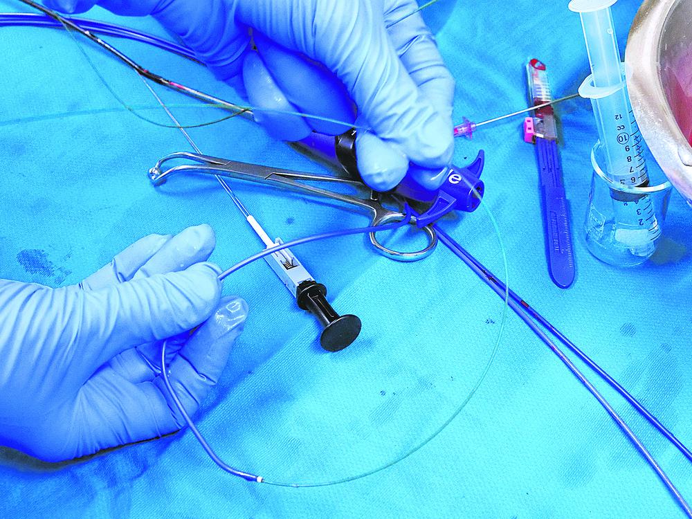 Mit Katheter, Ballon und Stent: Wie Ärzte per Katheter den Weg zum ...