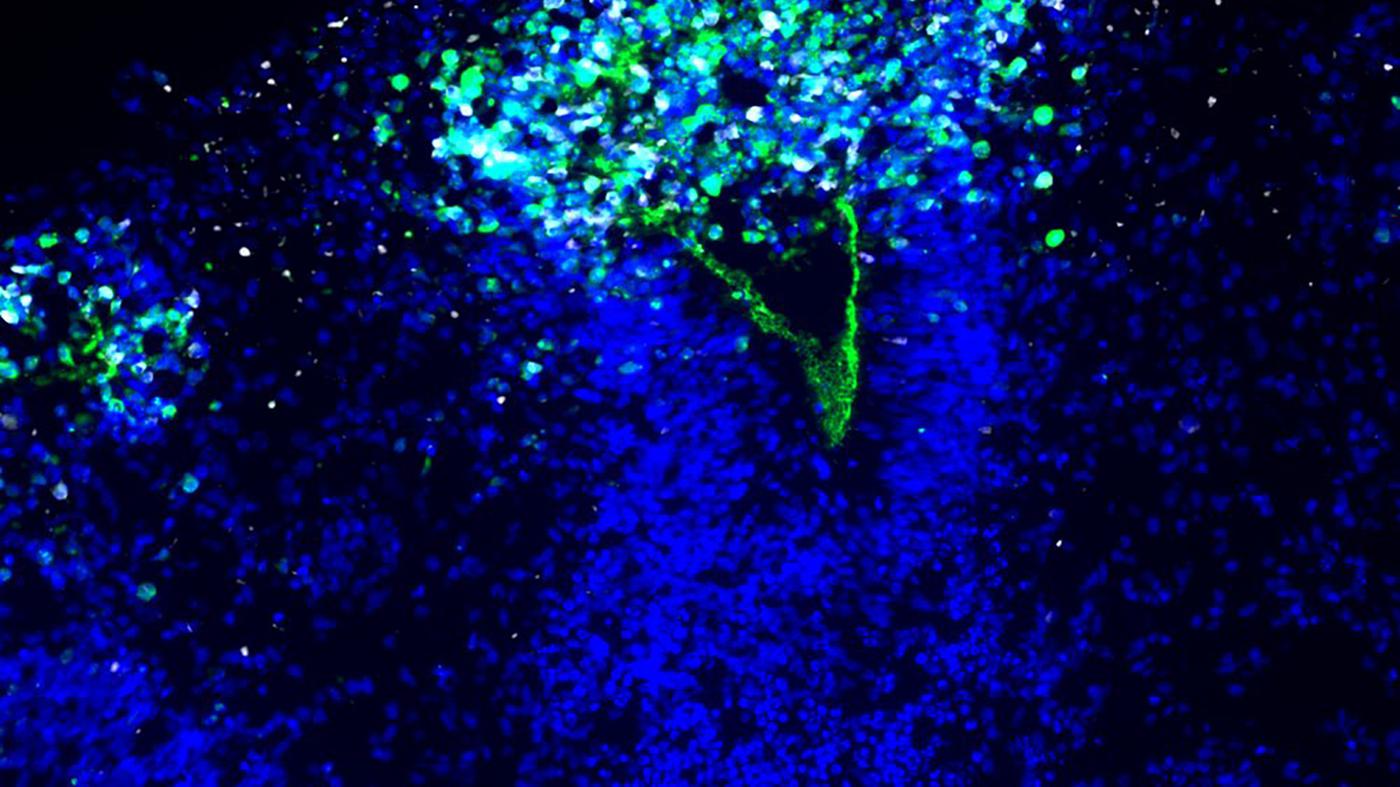 Herpes Simplex Virus 1 And Brain Infections Causes Symptoms And herpes-simplex-virus-1-and-brain-infections-causes-symptoms-and