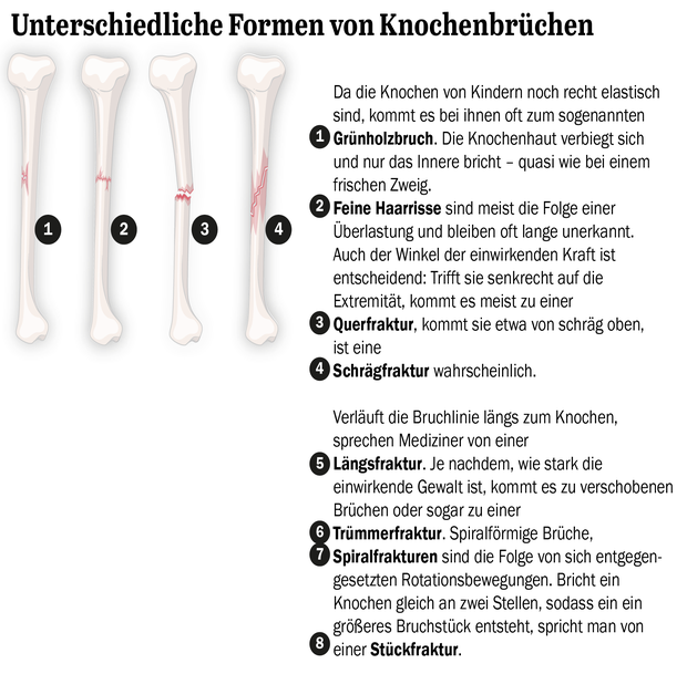 Knochenbrüche bei Kindern: Mit diesen Techniken heilen sie am ...